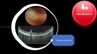 OCT biomarkers in uveitis.pptx