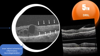 OCT biomarkers in uveitis.pptx