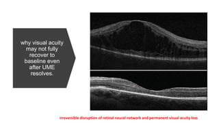 OCT biomarkers in uveitis.pptx