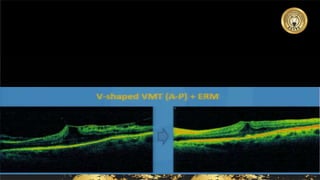 OCT biomarkers in uveitis.pptx
