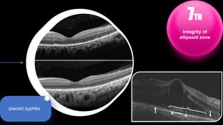 OCT biomarkers in uveitis.pptx