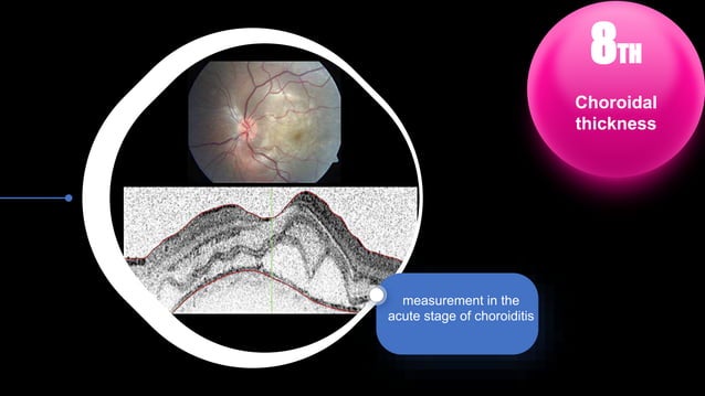 OCT biomarkers in uveitis.pptx