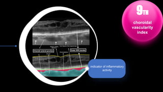 OCT biomarkers in uveitis.pptx