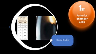 OCT biomarkers in uveitis.pptx