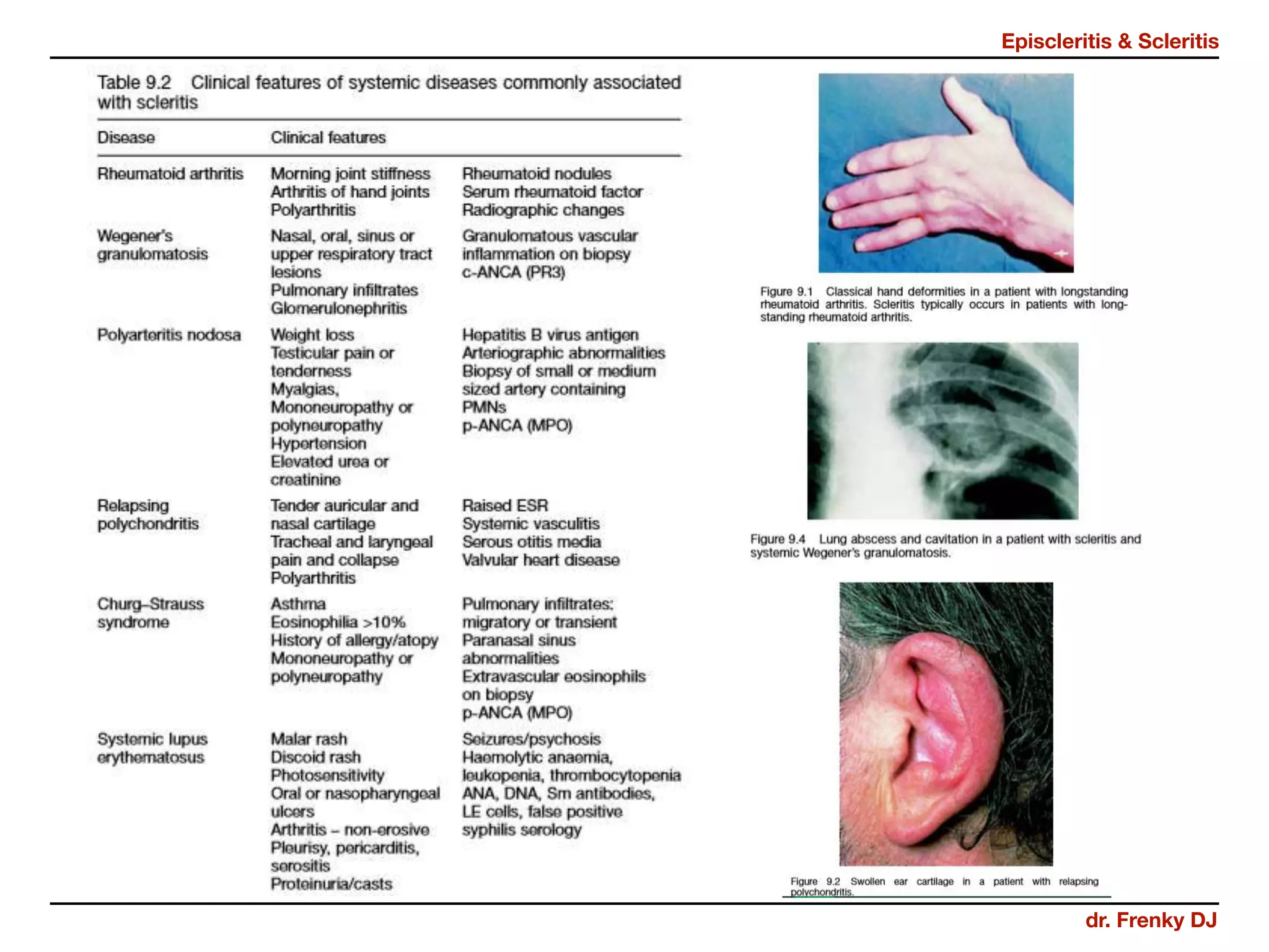 Episcleritis & Scleritis | PDF