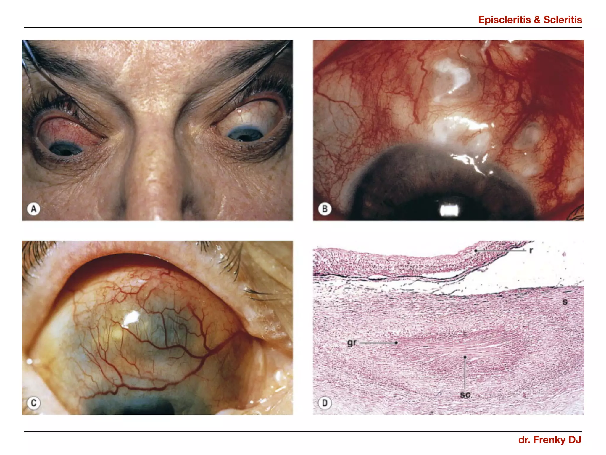 Episcleritis & Scleritis | PDF