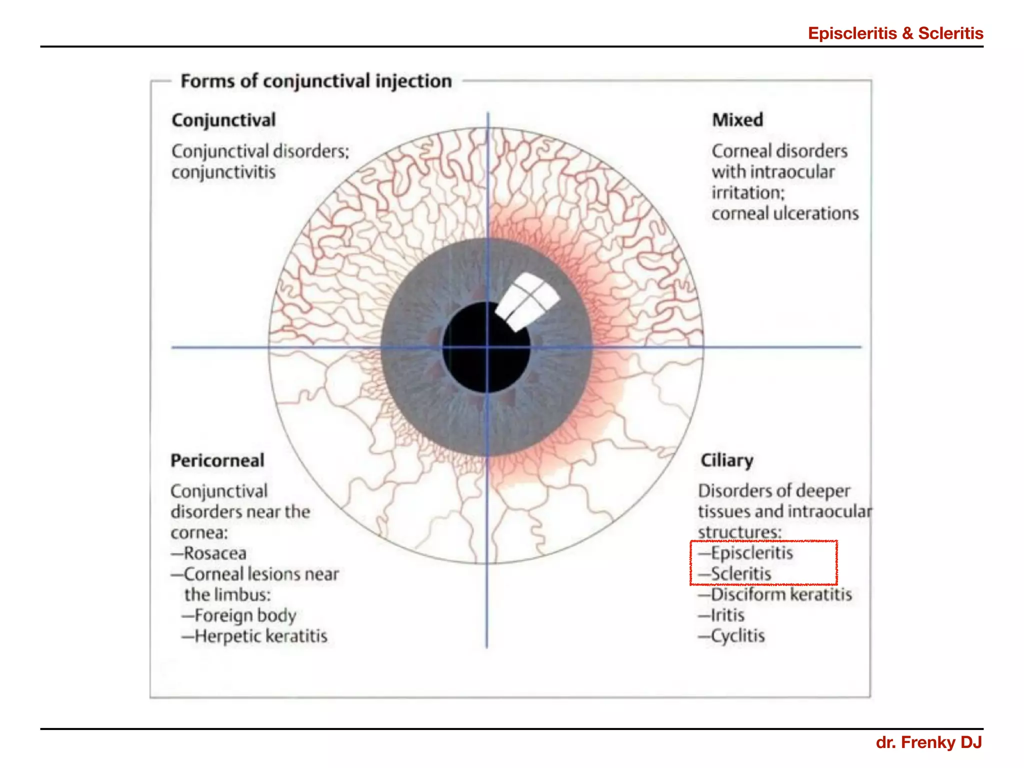 Episcleritis & Scleritis | PDF