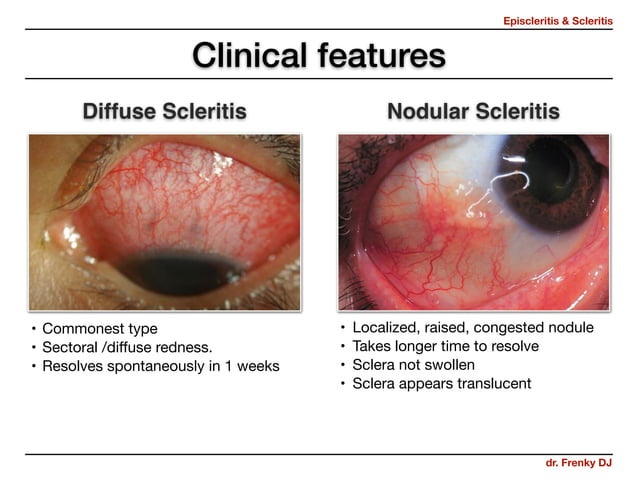 Episcleritis & Scleritis | PDF | Eye and Vision Conditions | Diseases ...