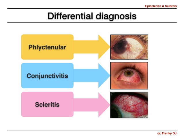 Episcleritis & Scleritis | PDF | Eye and Vision Conditions | Diseases ...