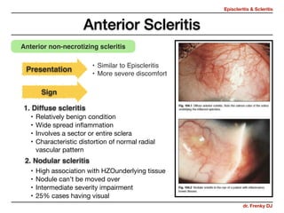 Episcleritis & Scleritis | PDF