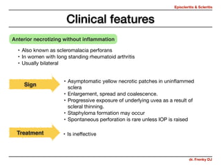 Episcleritis & Scleritis | PDF