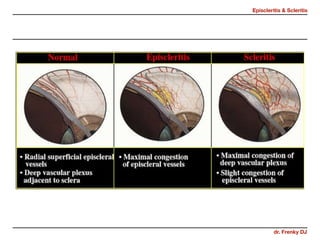 Episcleritis & Scleritis | PDF