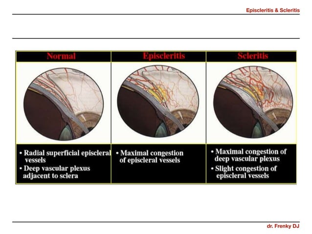 Episcleritis & Scleritis | PDF | Eye and Vision Conditions | Diseases ...