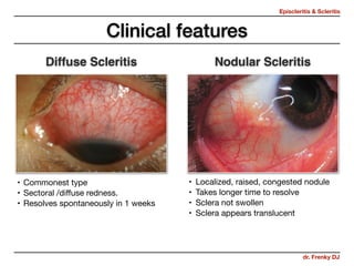 Nodular Episcleritis Eyeroundsorg Online Ophthalmic Atlas