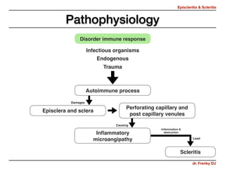 Episcleritis & Scleritis | PPT