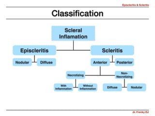 Episcleritis & Scleritis | PPT