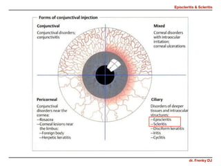Nodular Episcleritis Eyeroundsorg Online Ophthalmic Atlas