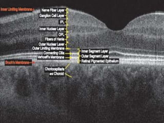 Oct guided diagnosis and treatment of pathologic myopic cnvm -AJAY ...