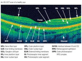 Oct guided diagnosis and treatment of pathologic myopic cnvm -AJAY ...