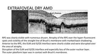 OCT IN DRY ARMD | PPTX