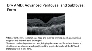 OCT IN DRY ARMD | PPTX