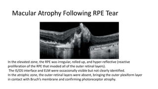 OCT IN DRY ARMD | PPTX