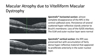 OCT IN DRY ARMD | PPTX