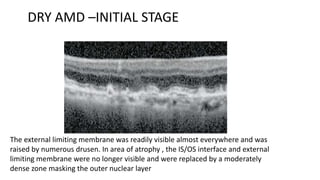 OCT IN DRY ARMD | PPTX