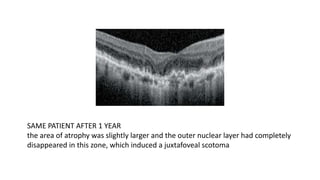 OCT IN DRY ARMD | PPTX