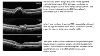 OCT IN DRY ARMD | PPTX