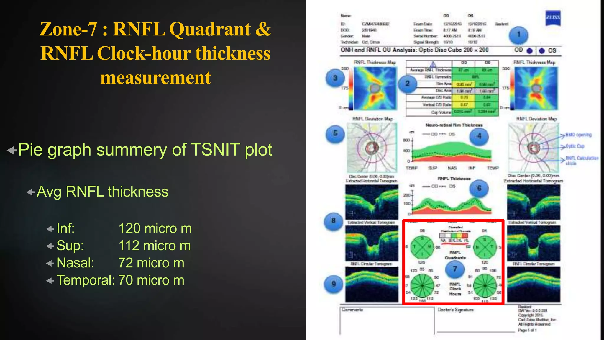 OCT in glaucoma ppt;1 | PPTX
