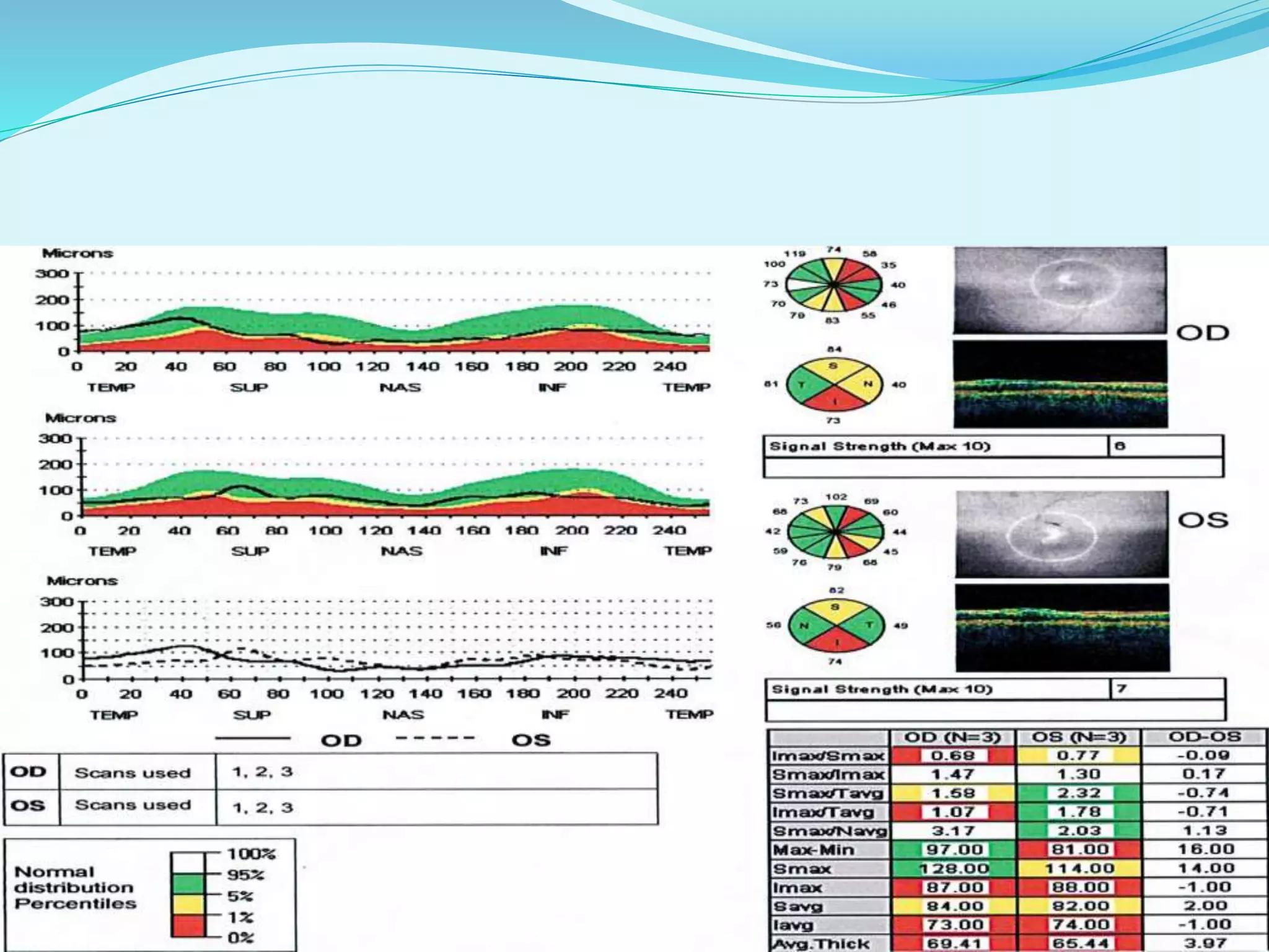 Oct in glaucoma | PPTX