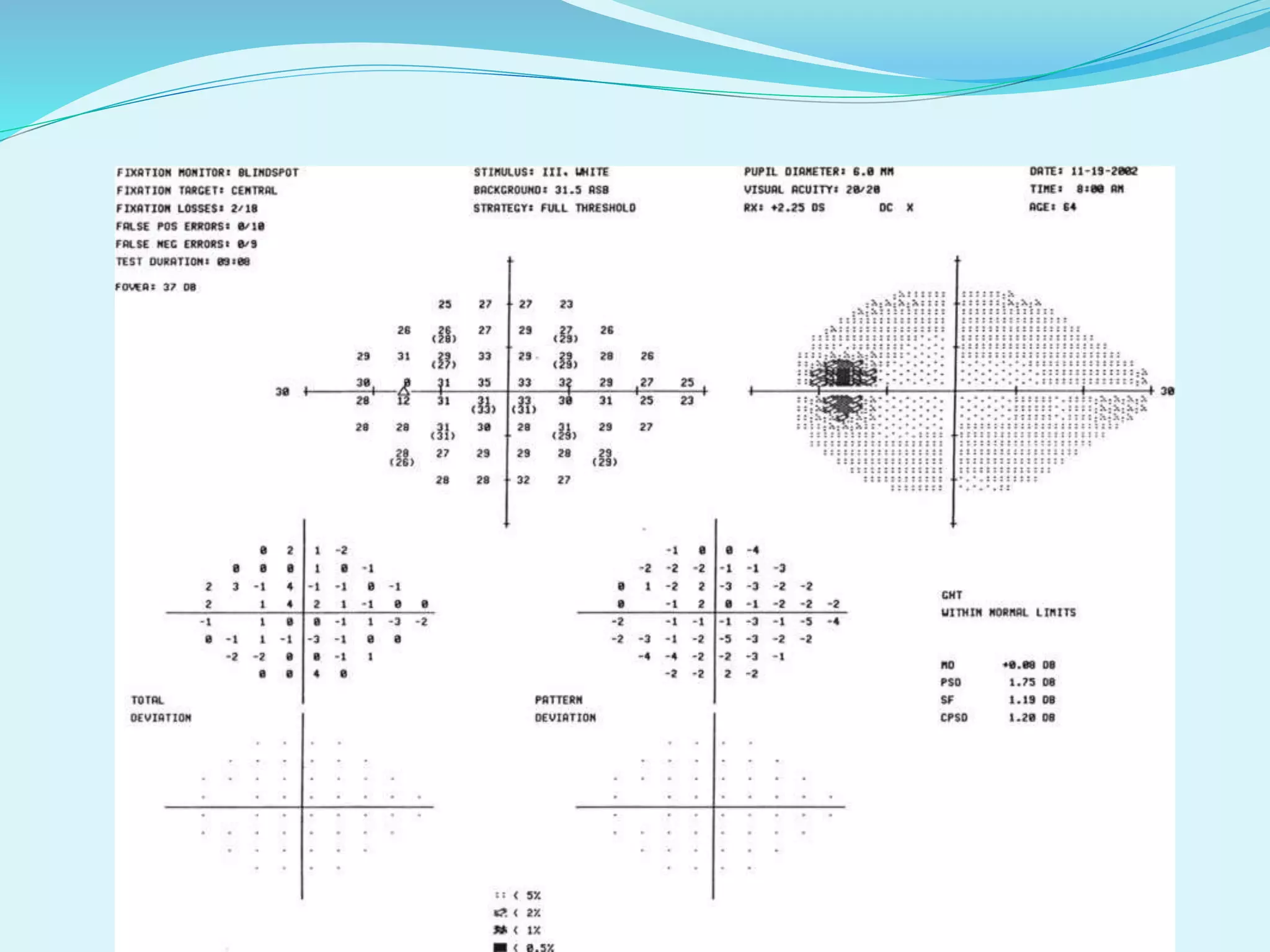 Oct in glaucoma | PPTX