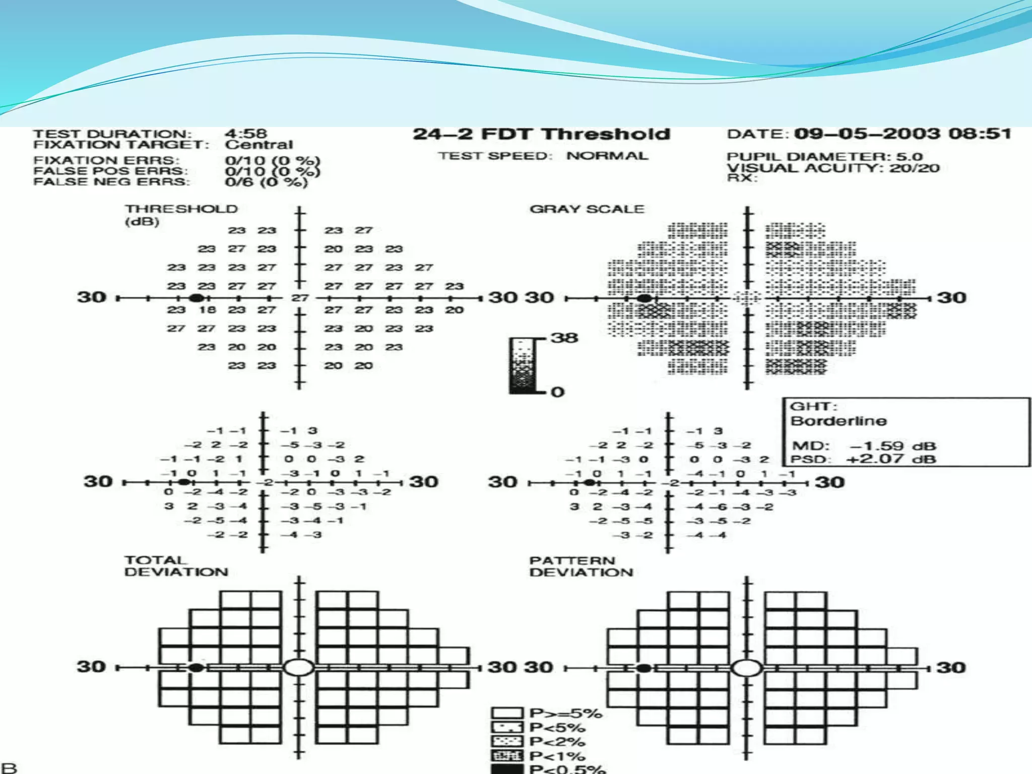 Oct in glaucoma | PPTX
