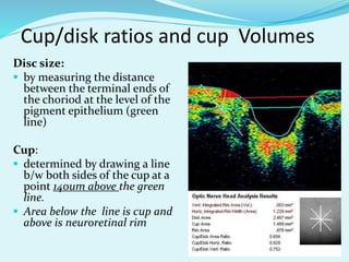 Oct in glaucoma | PPTX