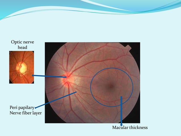 Oct in glaucoma | PPT