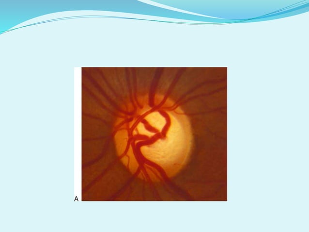 Oct in glaucoma | PPTX | Eye and Vision Conditions | Diseases and ...