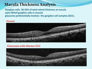 Oct in glaucoma | PPTX