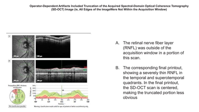 OCT IN DIAGNOSIS OF GLAUCOMA &MISINTERPRETATION &ARTEFACTS IN THE ...