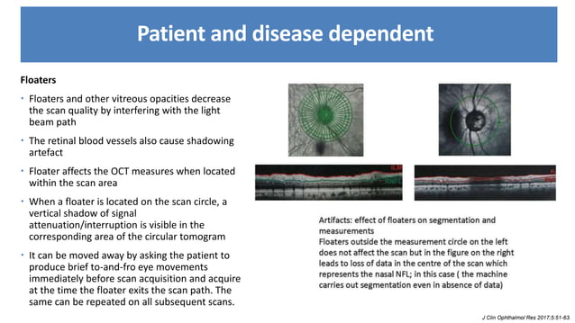 OCT IN DIAGNOSIS OF GLAUCOMA &MISINTERPRETATION &ARTEFACTS IN THE ...