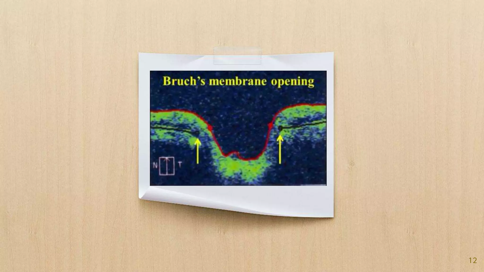 Interpretation of OCT(Glaucoma) | PPTX