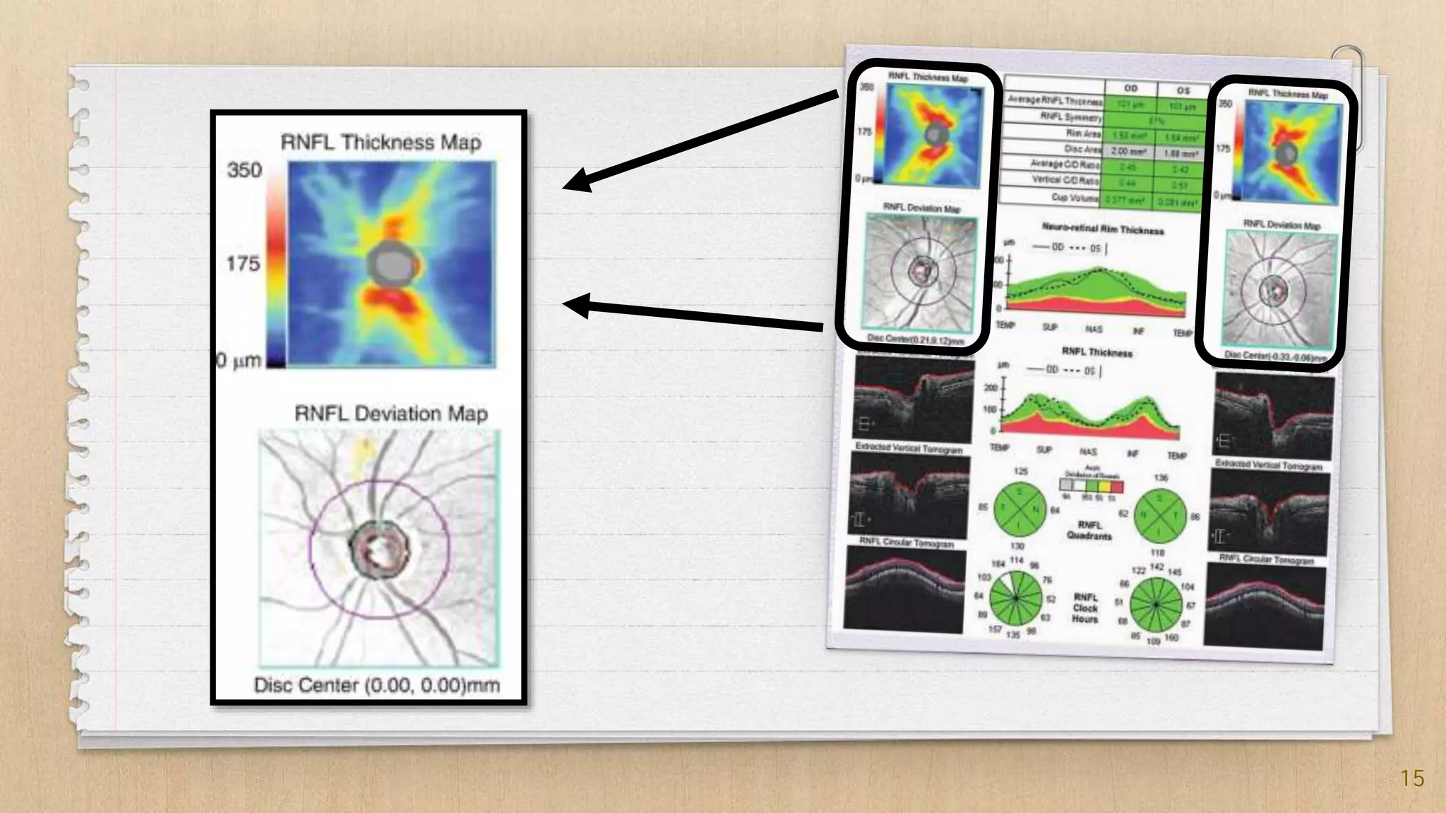 Interpretation of OCT(Glaucoma) | PPTX