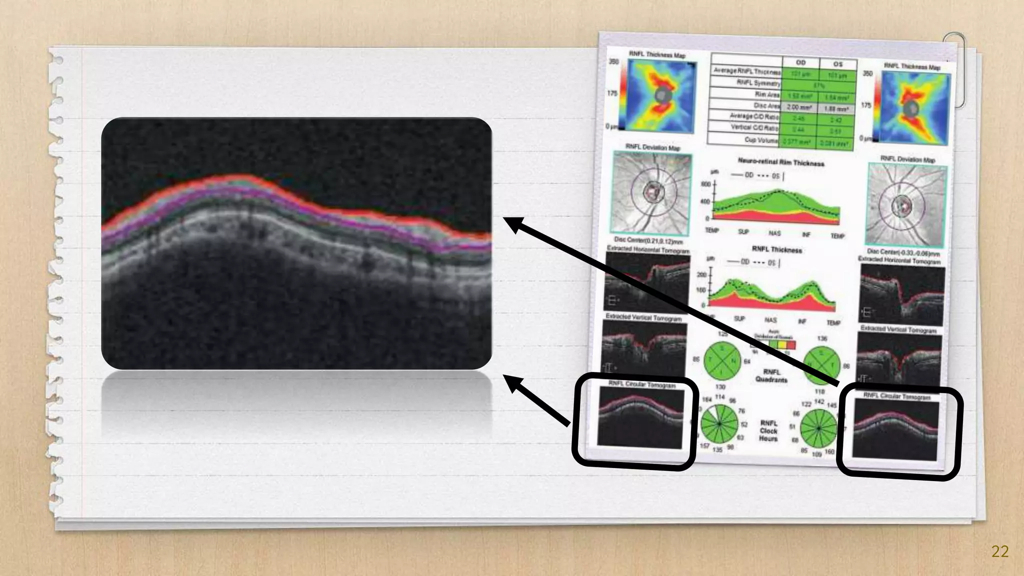 Interpretation of OCT(Glaucoma) | PPTX