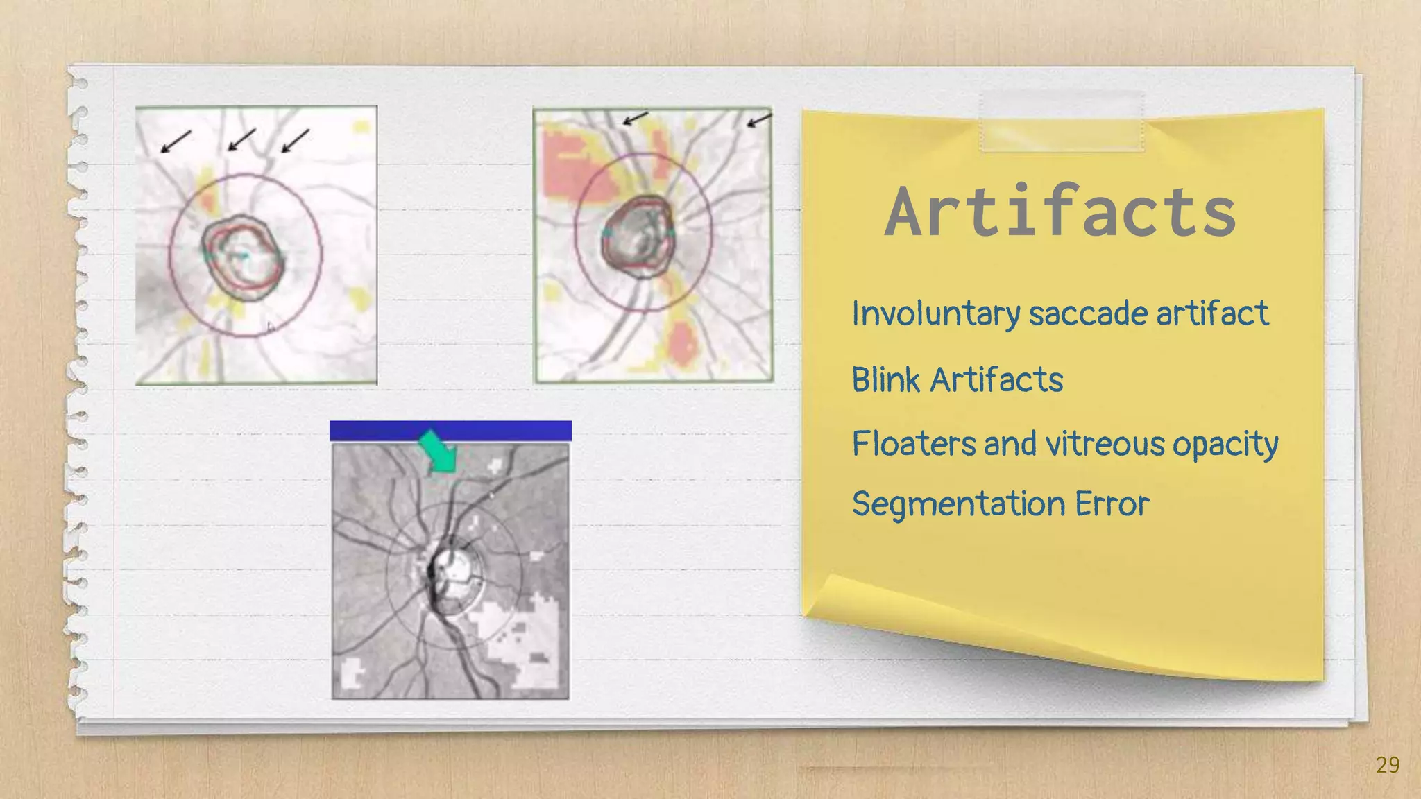 Interpretation of OCT(Glaucoma) | PPTX