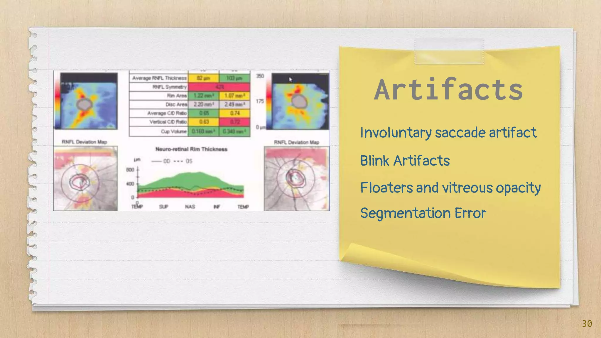 Interpretation of OCT(Glaucoma) | PPTX