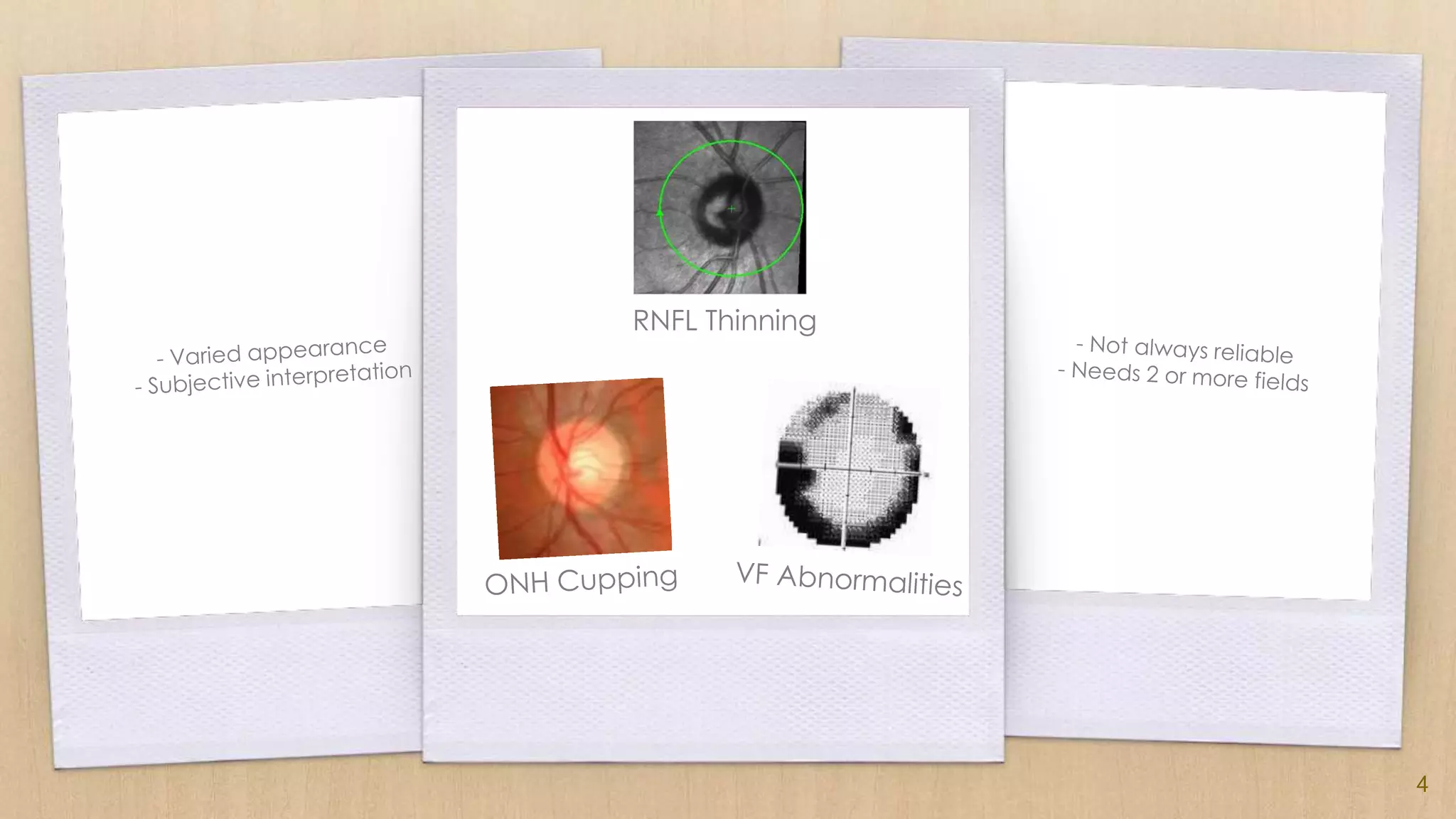 Interpretation of OCT(Glaucoma) | PPTX