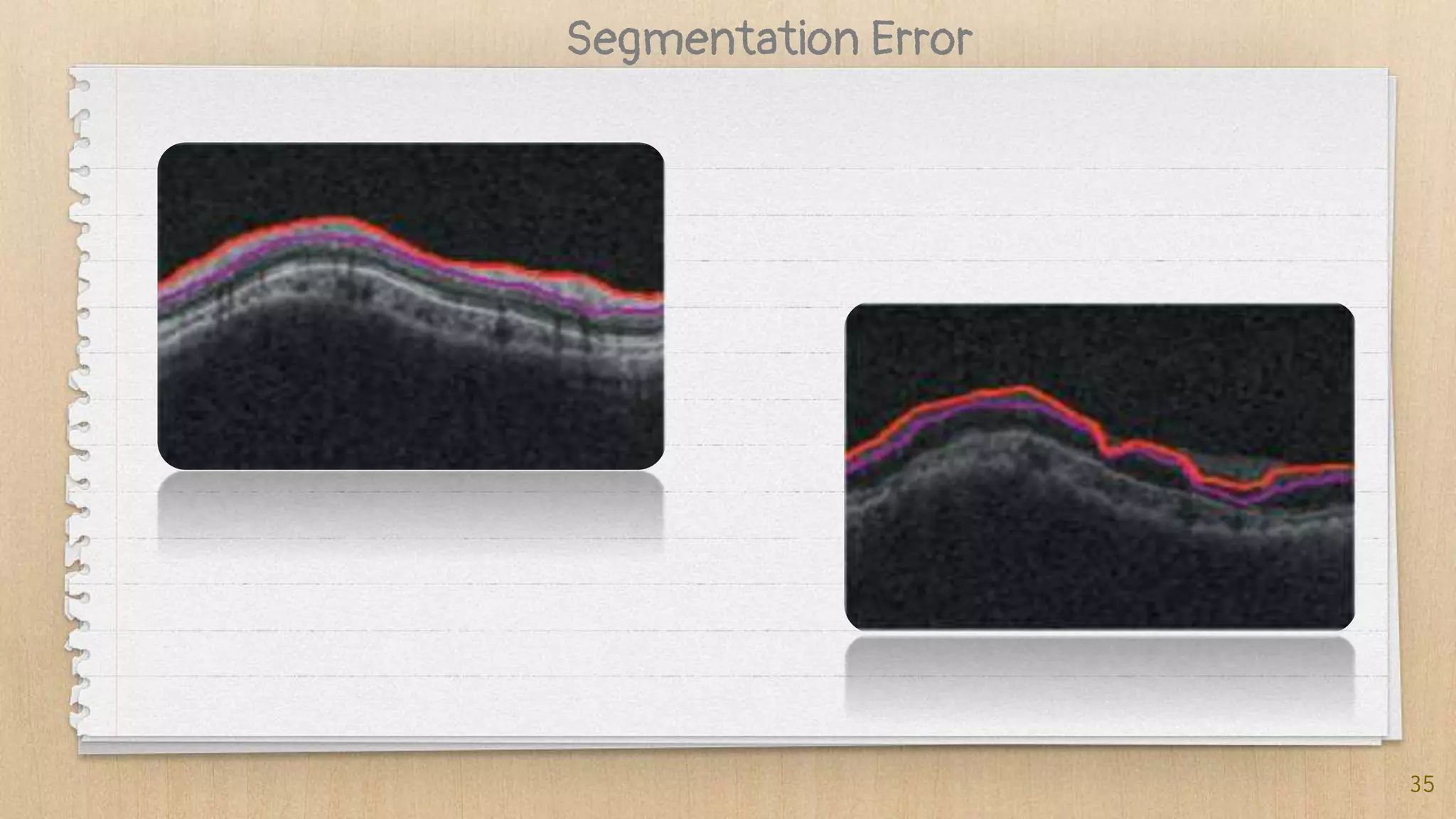 Interpretation of OCT(Glaucoma) | PPTX