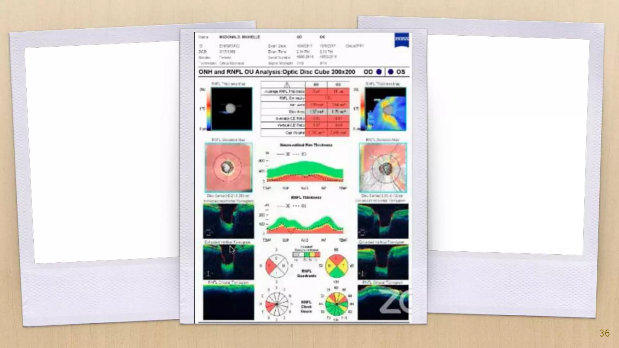 Interpretation of OCT(Glaucoma) | PPTX