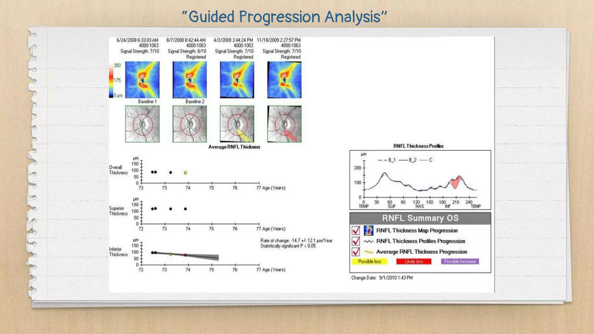 Interpretation of OCT(Glaucoma) | PPTX