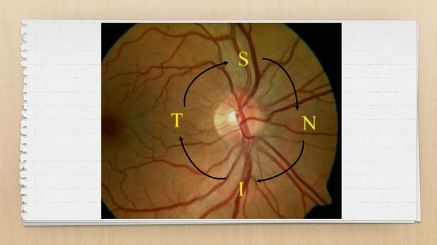 Interpretation of OCT(Glaucoma) | PPTX